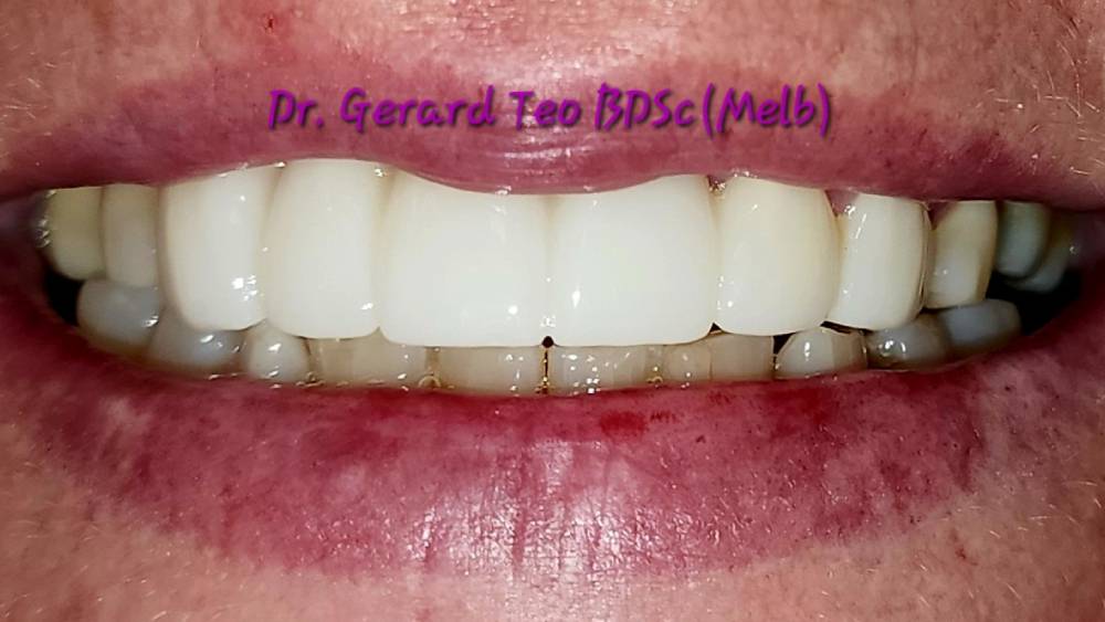 Smile Gallery New Oct23 - Geelong West Dental